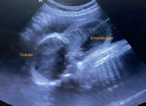 Ecografía De Encefalocele ENCEFALOCELE