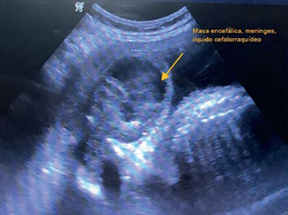 Defecto del tubo neural: encefalocele occipital. Reporte de caso