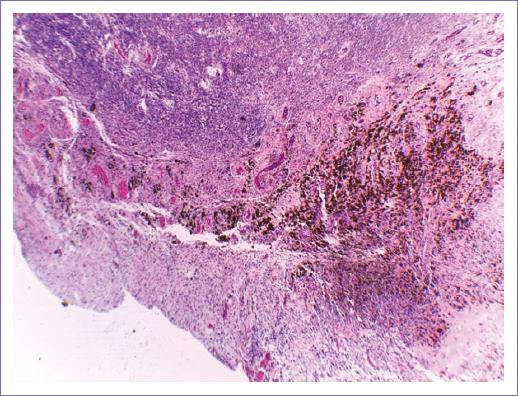 Tumor anexial en el síndrome de Mayer-Rokitansky-Küster- Hauser ...