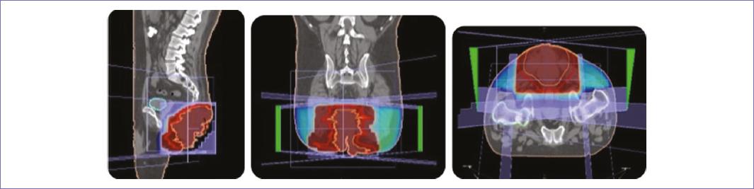 Condiloma acuminado gigante (tumor de Buschke-Löwenstein) de región ...