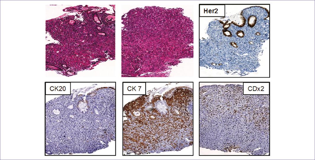 Coagulación intravascular diseminada asociada a cáncer gástrico ...