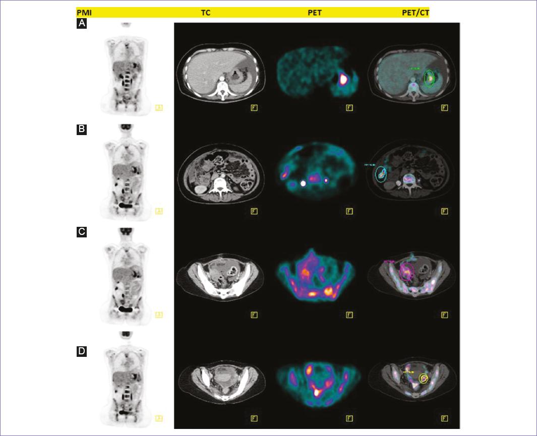Coagulación intravascular diseminada asociada a cáncer gástrico ...