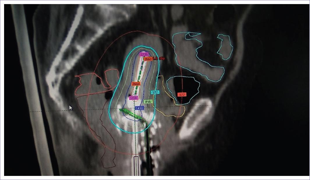 Dosimetría del intestino delgado como órgano de riesgo en la ...