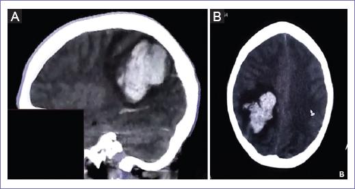 Acrometástasis como presentación inusual de progresión de enfermedad en ...