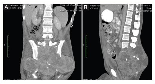Hemicorporectomía (amputación translumbar) como tratamiento en tumor de ...