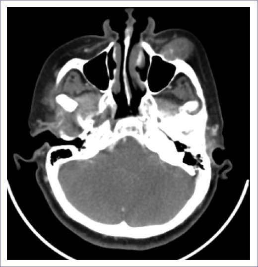 Myoepithelial carcinoma: A case report of a rare pathology of the ...