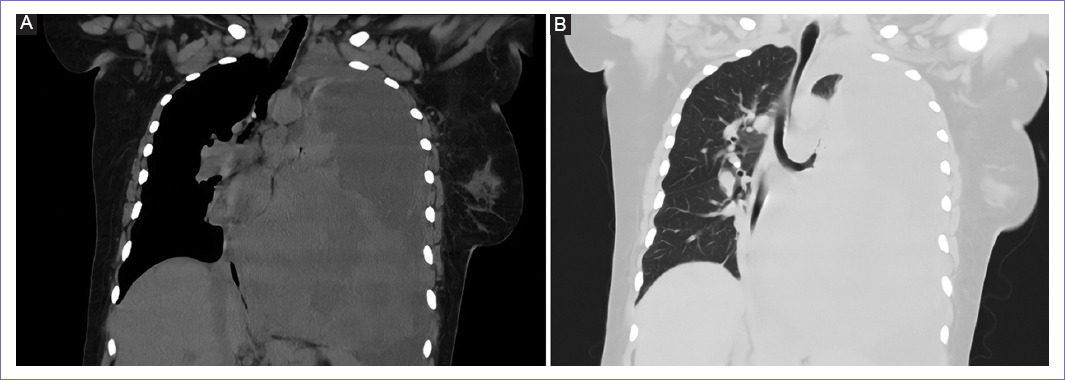 Metástasis pulmonar por sarcoma uterino indiferenciado: primer caso ...