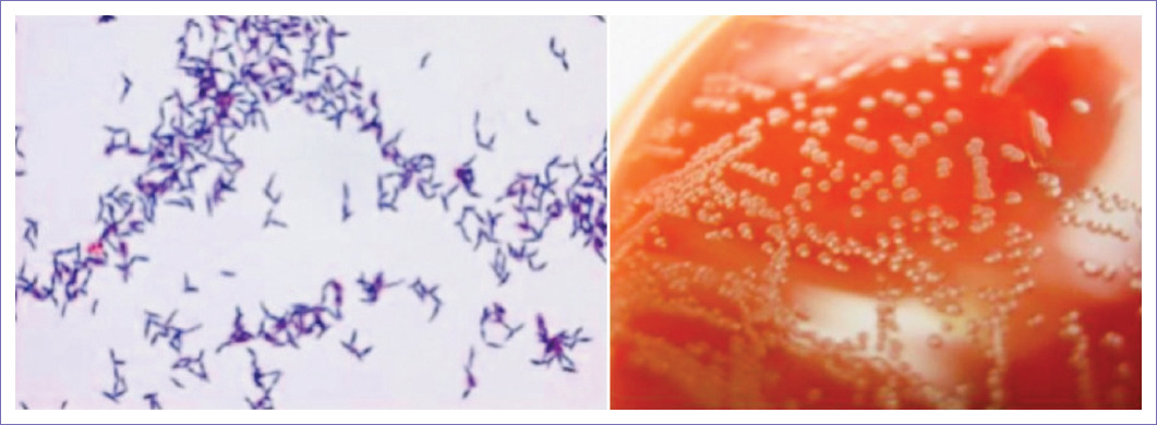 Choque séptico por Actinomyces turicensis, asociado a cáncer de cérvix ...