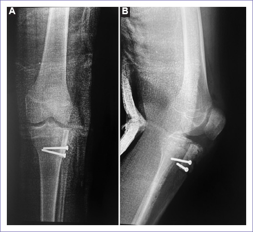 Quiste óseo aneurismático de tibia proximal: reporte de un caso