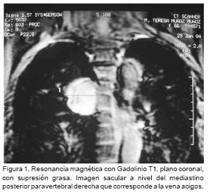 Aneurisma de la vena acigos