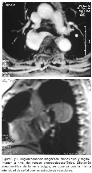 Aneurisma de la vena acigos