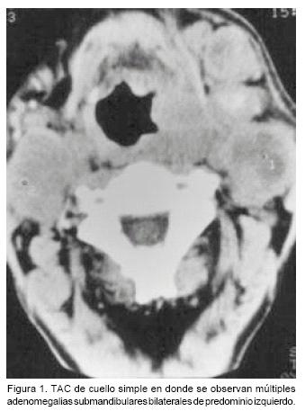 A 66 Year–Old male with a submandibular mass, fever and productive cough