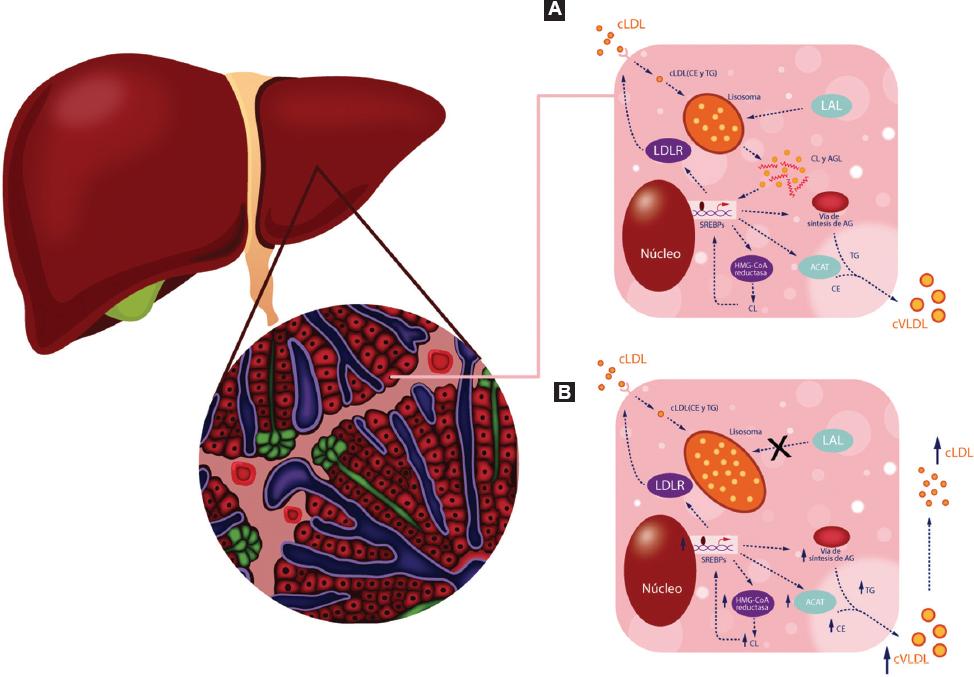 Deficiencia de lipasa ácida lisosomal, una patología infrecuente