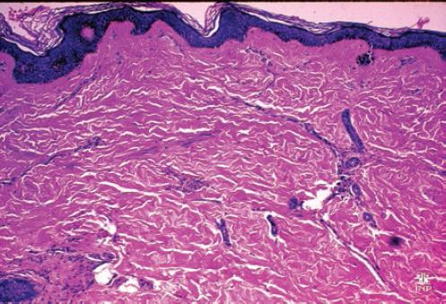Morphea: a practical review of its diagnosis, classification and treatment