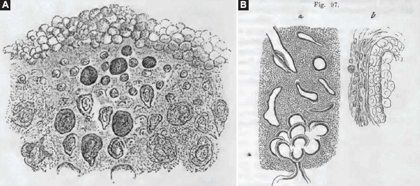 Carl von Rokitansky, el Linneo de la anatomía patológica