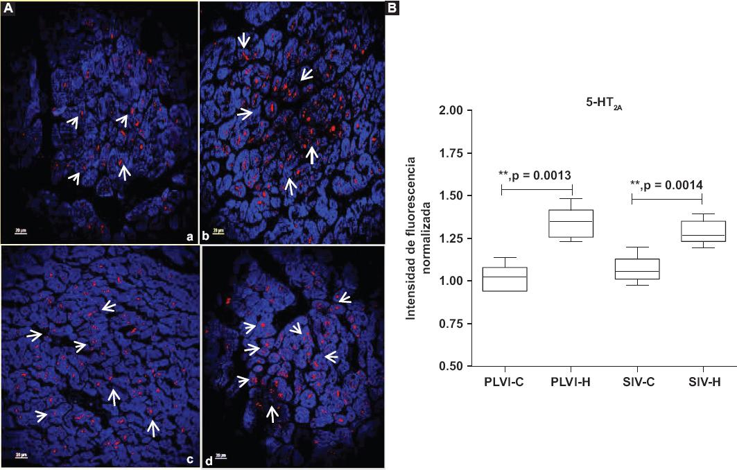 La miocardiopatía hipertrófica induce cambios en la expresión de la ...