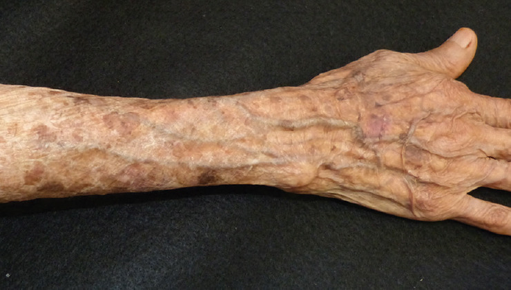 Factores asociados a dermatoporosis en una muestra de pacientes ...