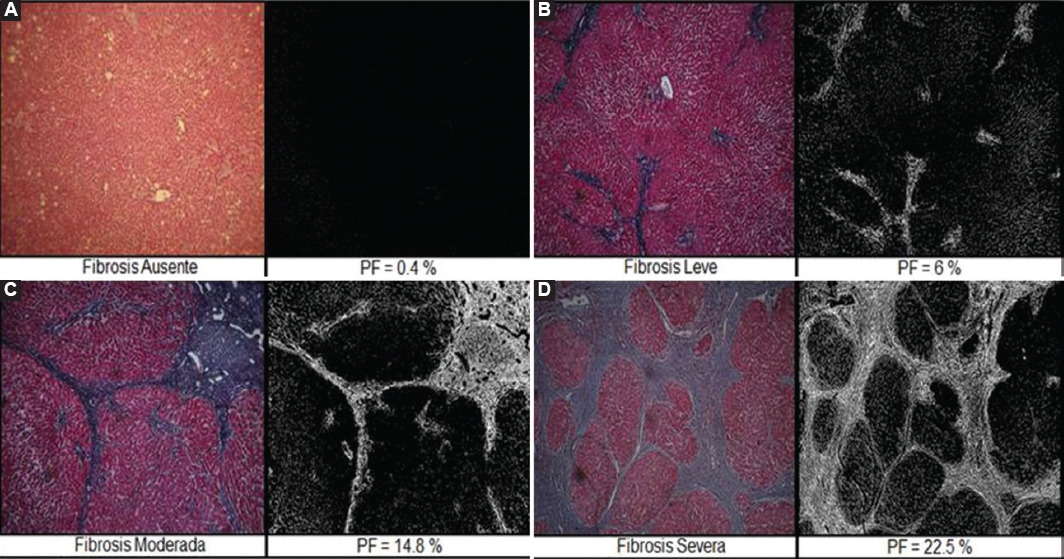 Correlación de la cuantificación de fibrosis hepática por morfometría ...