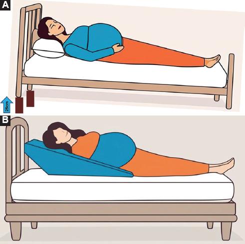 Enfermedad por reflujo gastroesofágico y embarazo: recomendaciones para ...