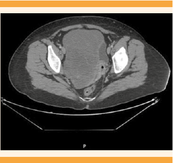 Angiomixoma agresivo: reporte de un caso y experiencia global con 168 casos