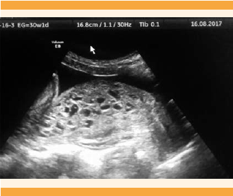 Embarazo molar con feto vivo y éxito perinatal. Reporte de un caso y ...