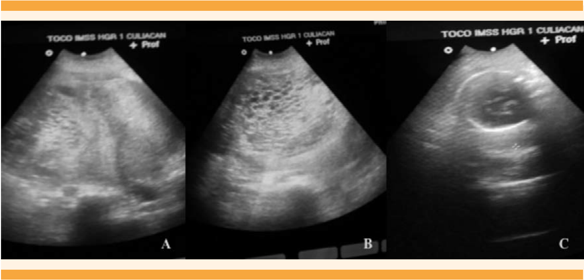 Mola hidatiforme coexistente con feto vivo después de las 20 semanas de ...