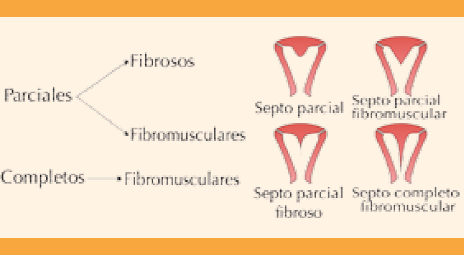 Fertilidad posterior a la septoplastia histeroscópica de consultorio ...