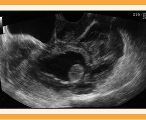 Embarazo ectópico abdominal en una paciente histerectomizada