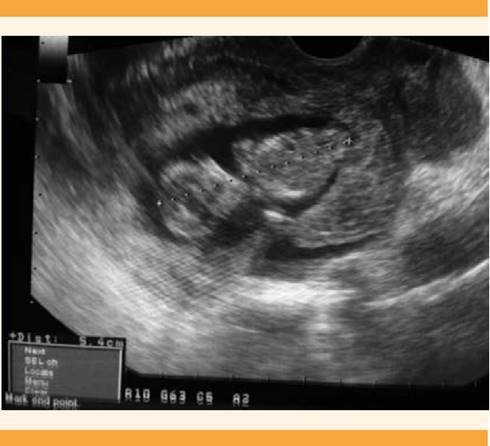 Embarazo ectópico abdominal en una paciente histerectomizada