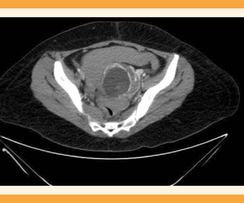 Embarazo ectópico abdominal en una paciente histerectomizada