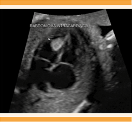 Tumores cardiacos fetales: importancia del diagnóstico prenatal y ...