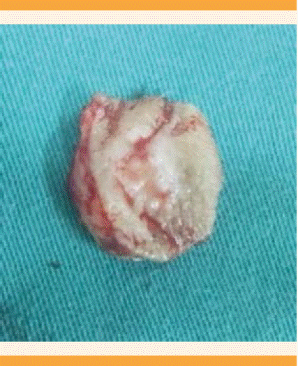 Basal cell carcinoma of the vulva: A rare presentation of a common disease