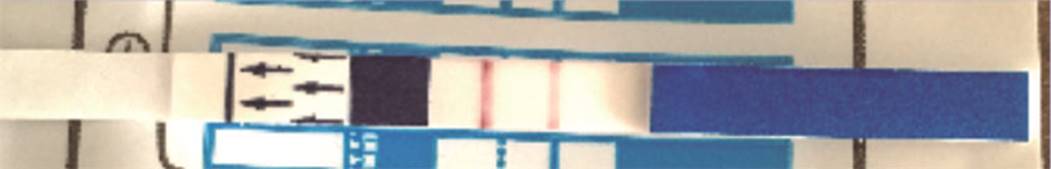 Comparación de la eficacia de la α-microglobulina-1 placentaria vs ...