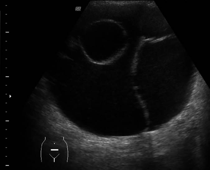 Ultrassonografia De Fibroma Ovariano FIBROTECOMA BILATERAL DE OVARIO
