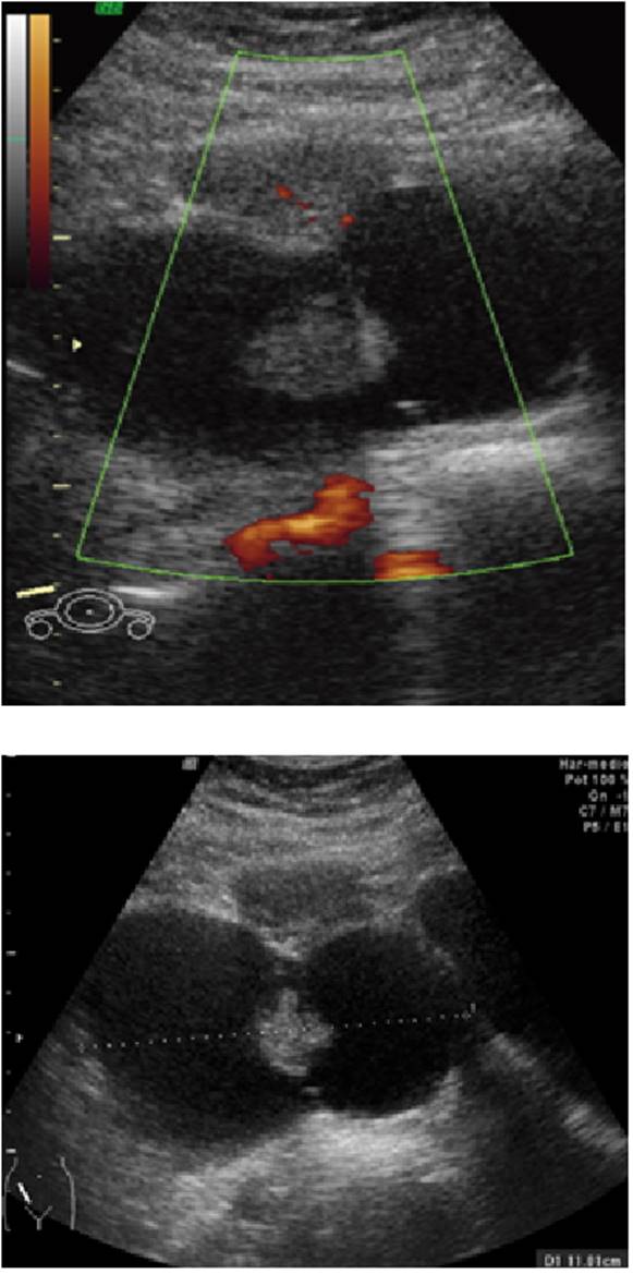Ultrassonografia De Fibroma Ovariano FIBROTECOMA BILATERAL DE OVARIO
