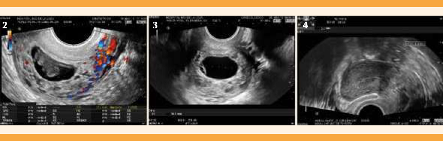 Embarazo cervical tratado de forma divergente. Reporte de dos casos