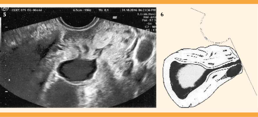 Embarazo cervical tratado de forma divergente. Reporte de dos casos