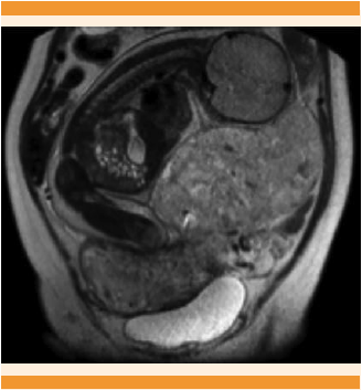 Embarazo ectópico abdominal de término con neonato vivo: caso clínico y ...