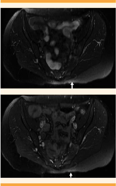 Bacteriemia con afectación inflamatoria pélvica y miositis secundaria a ...