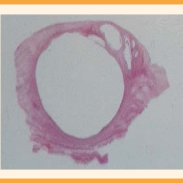 Quiste De Naboth Aandoeningen