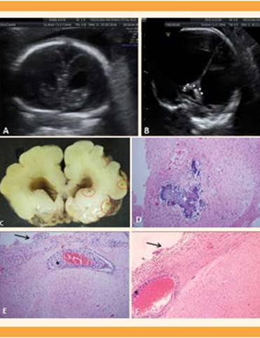 Caracterización ecográfica y anatomopatológica de pacientes con ...