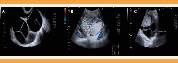 Mola invasiva en adolescente de 13 años. Aspectos fundamentales del ...