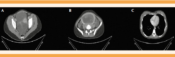 Mola invasiva en adolescente de 13 años. Aspectos fundamentales del ...