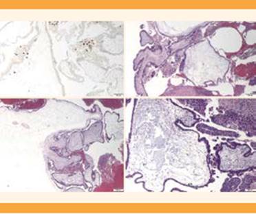 Mola invasiva en adolescente de 13 años. Aspectos fundamentales del ...