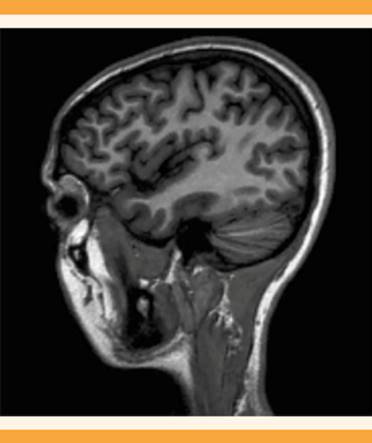 Mola invasiva en adolescente de 13 años. Aspectos fundamentales del ...