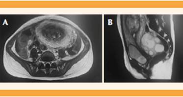 Mola invasiva en adolescente de 13 años. Aspectos fundamentales del ...
