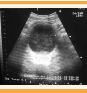 Himen imperforado y hematocolpos por retención urinaria y dolor ...