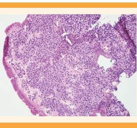 Plasmocitoma de cuello uterino. Informe de un caso y revisión de la ...