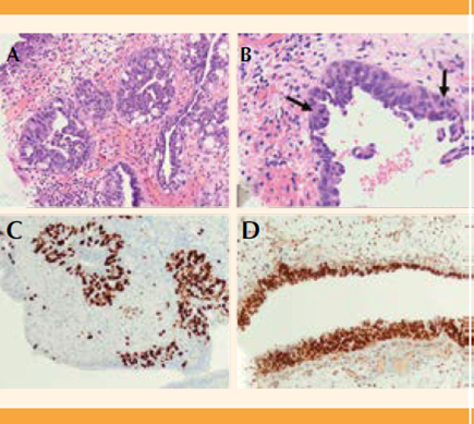 Carcinoma intraepitelial tubárico seroso como hallazgo posquirúrgico de ...