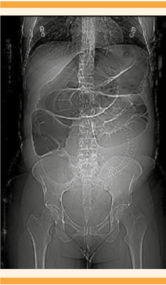 Vólvulo colónico recidivado en una mujer embarazada: tratamiento ...